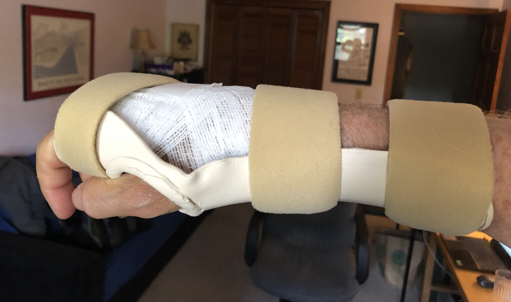 Hey, I got my stitches out! | bradwarthen.com